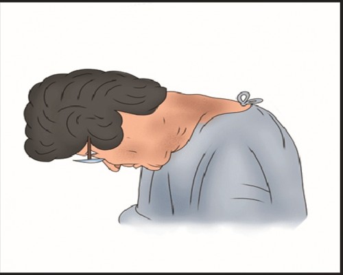 Excessive Phone Use Causes Neck Deformity in Youth: Case of ‘Drooping ...